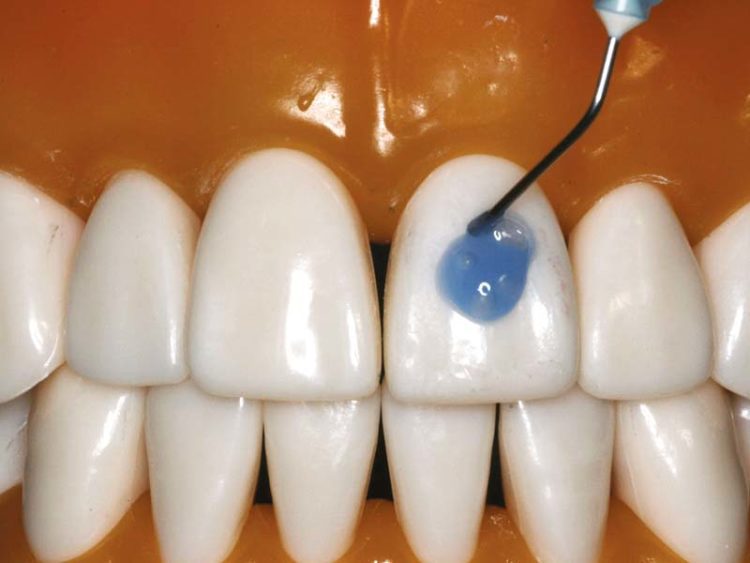 OBA, adhesivo para brackets de ortodoncia - PULPDENT